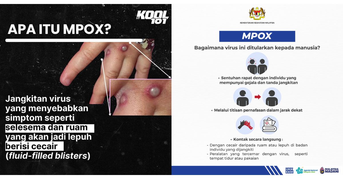 Mpox: Maksud, Penyebaran, Simptom dan Langkah Pencegahan